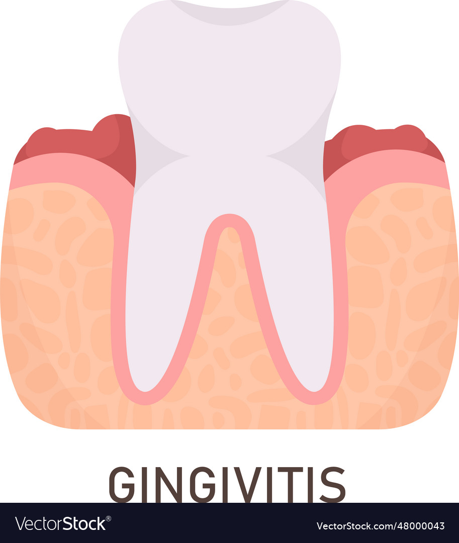 Gingivitis tooth problem Royalty Free Vector Image