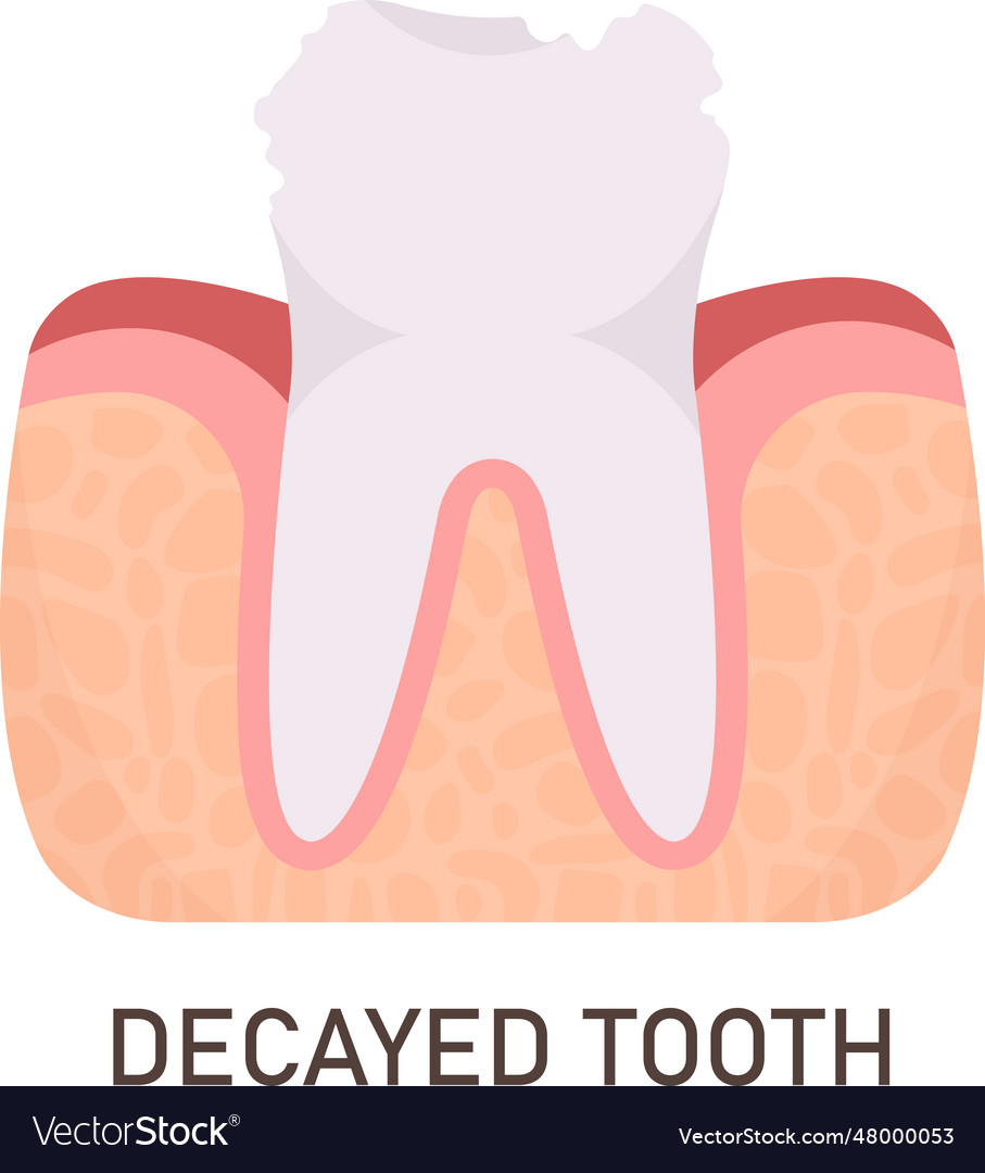 Decayed tooth problem Royalty Free Vector Image