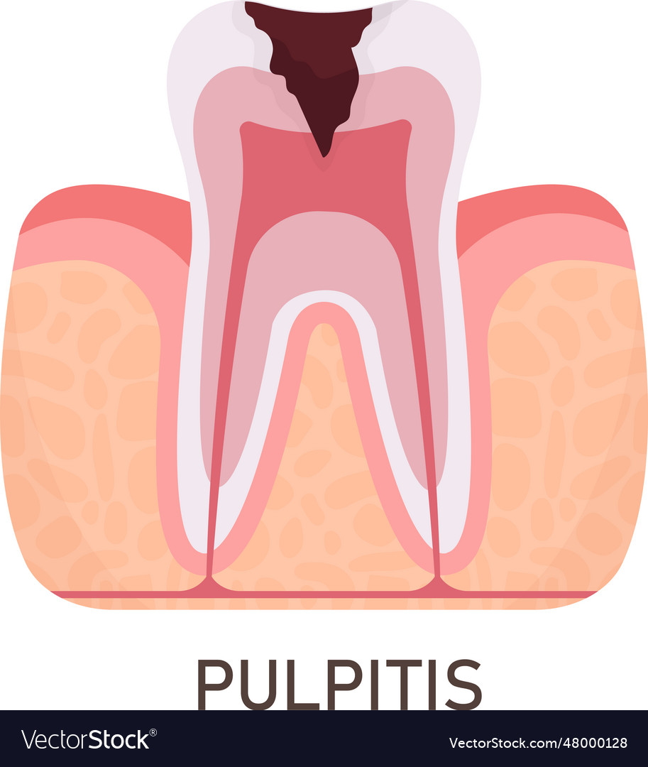 Pulpitis tooth problem Royalty Free Vector Image