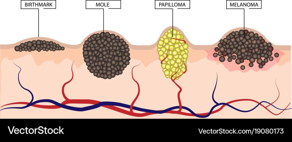 Difference between a birthmark mole Royalty Free Vector