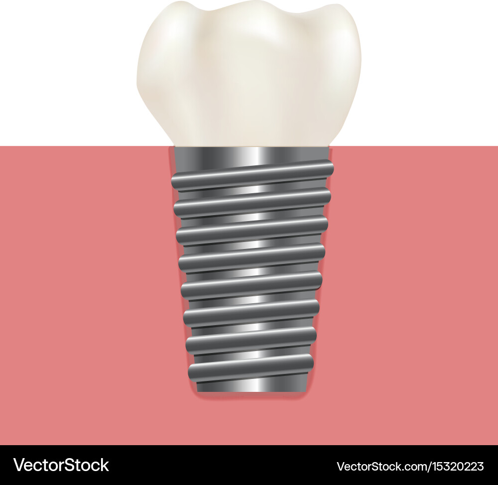 Realistic human dental implant Royalty Free Vector Image