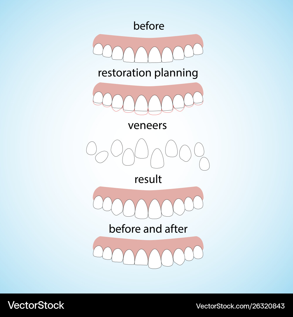 Veneers dentistry great design for any purposes Vector Image