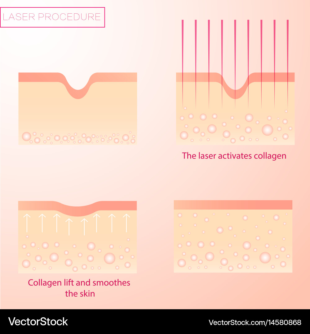 Procedure laser rejuvenation resurfacing skin Vector Image