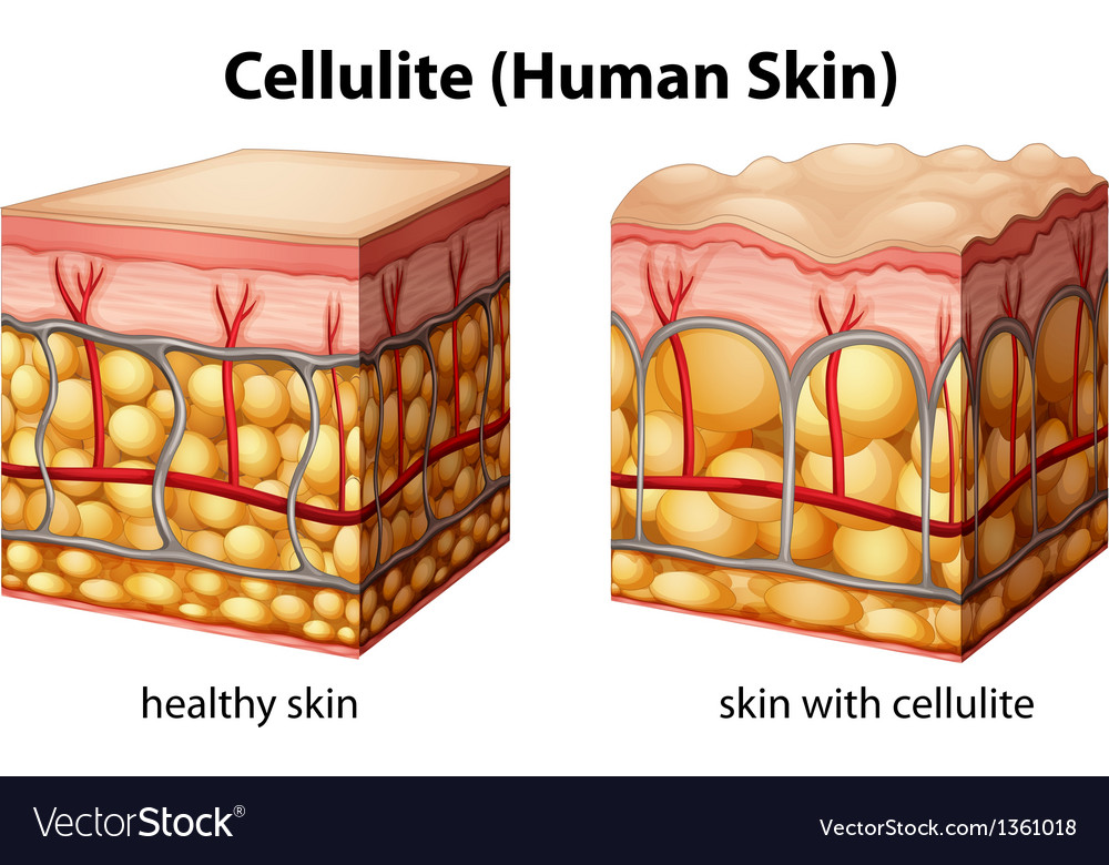 Cellulite Royalty Free Vector Image - VectorStock