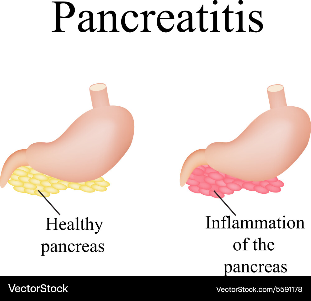 Inflammation pancreas pancreatitis Royalty Free Vector Image