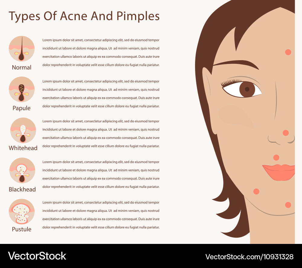 Types of acne and pimples Royalty Free Vector Image