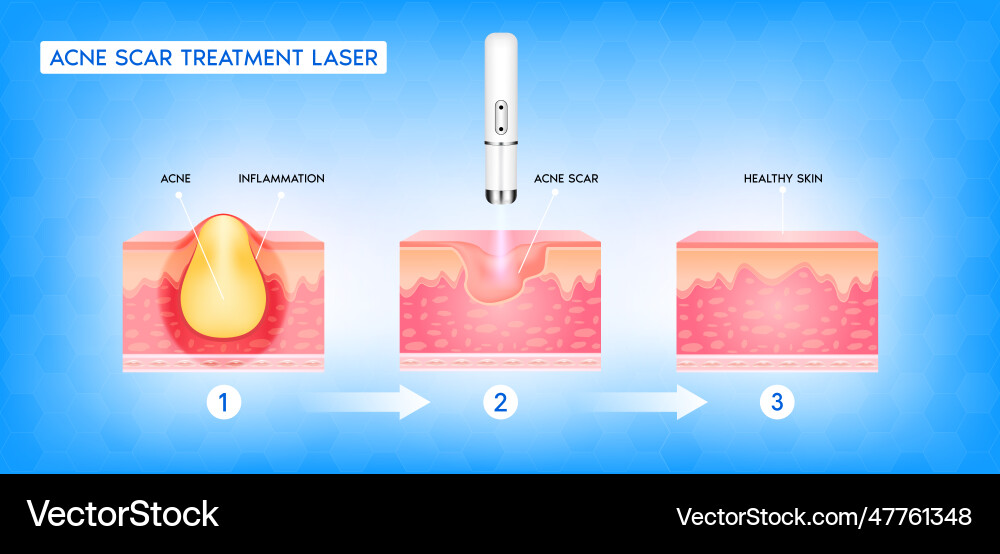 Acne scar vascular laser treatment Royalty Free Vector Image