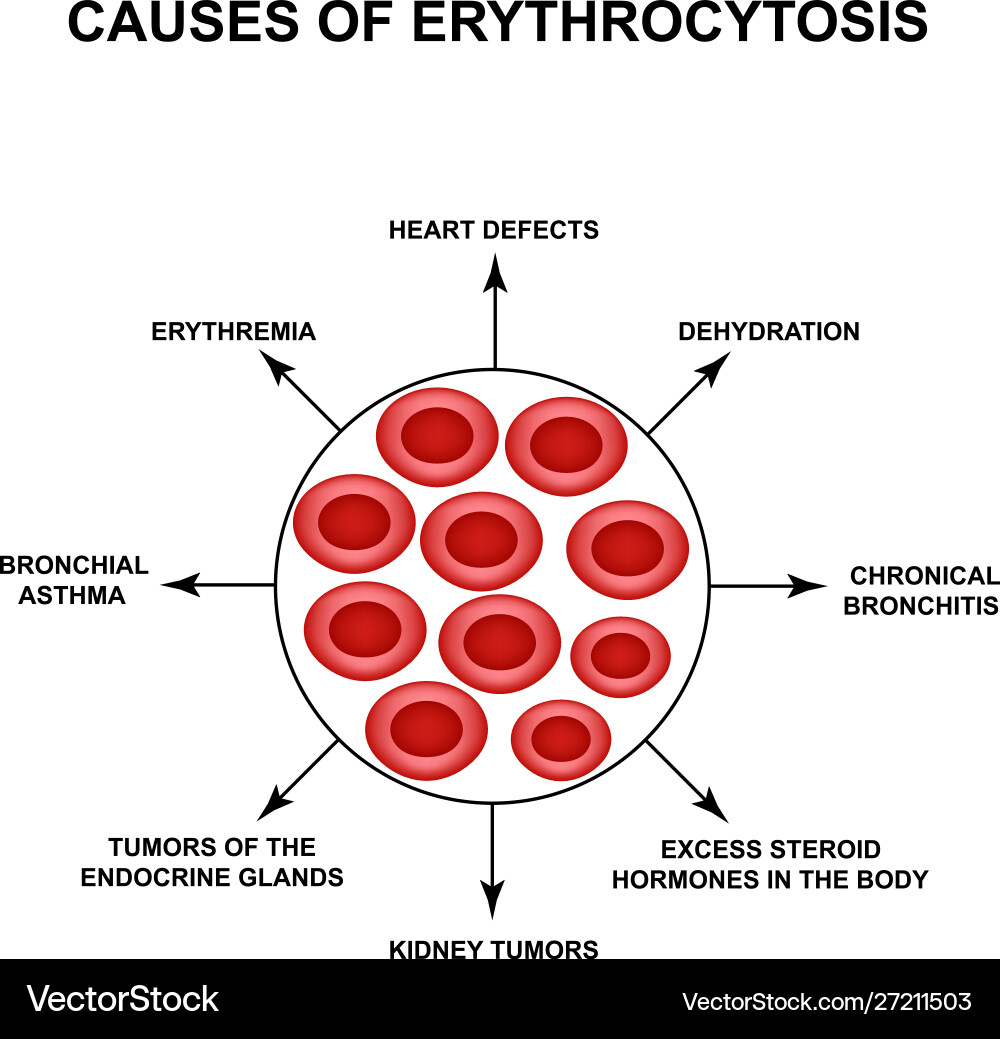 Causes erythrocytosis causes increased red Vector Image