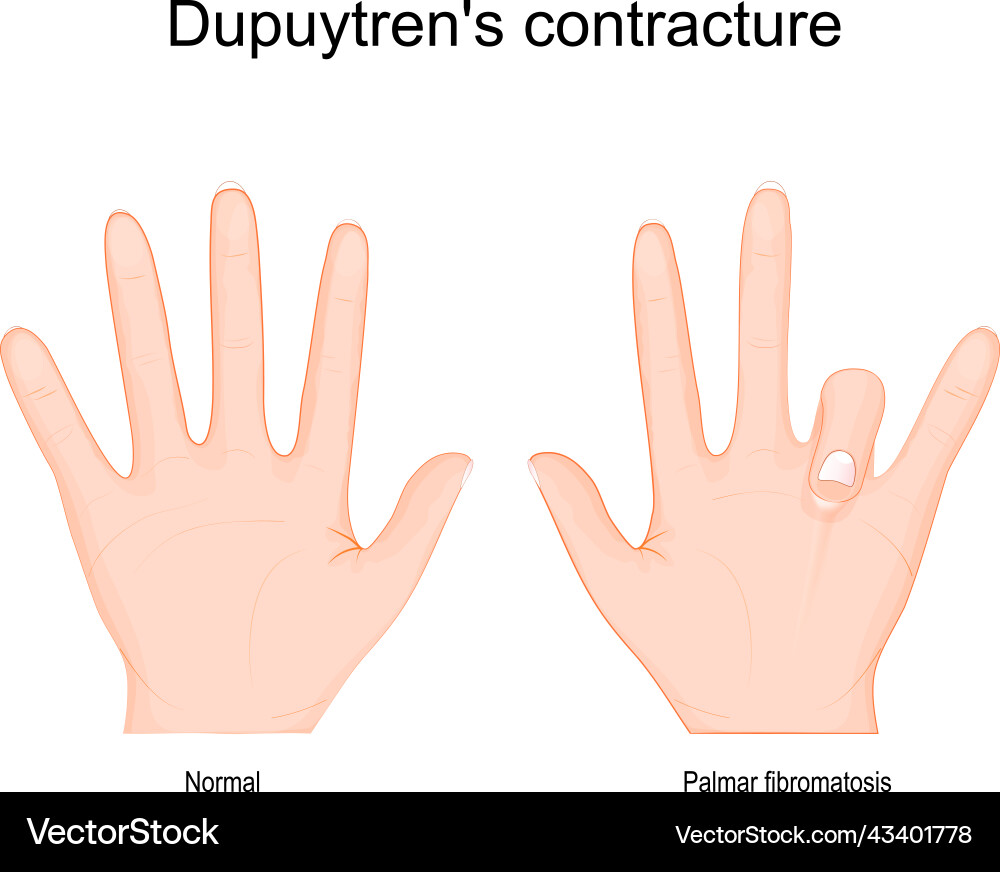 Dupuytrens contracture comparison and difference Vector Image