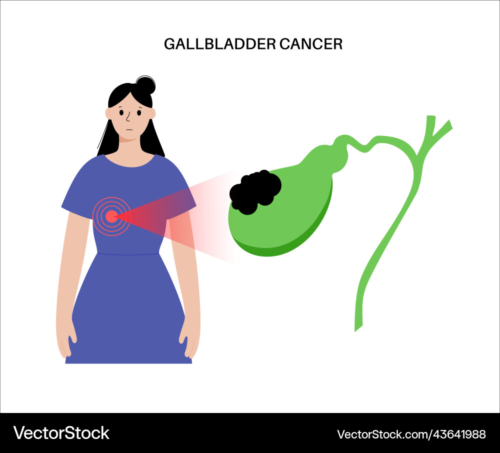 Gallbladder cancer anatomy Royalty Free Vector Image