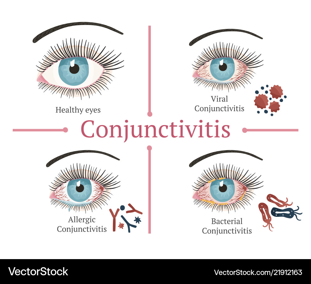 Eye disease ophthalmology health Royalty Free Vector Image