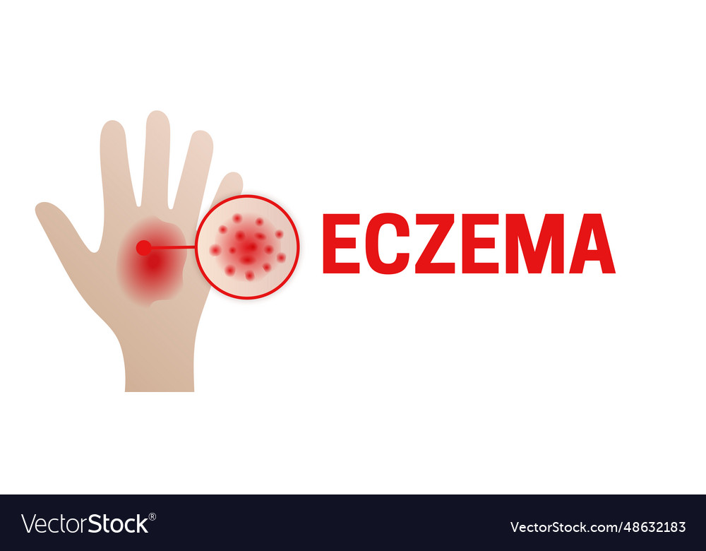 Eczema background design Royalty Free Vector Image