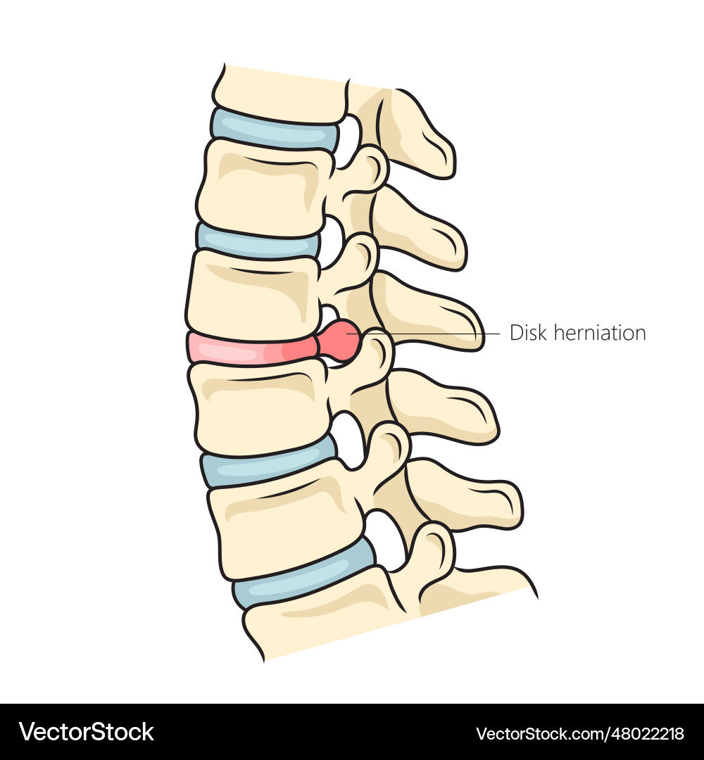 Spinal disc herniation diagram medical science Vector Image
