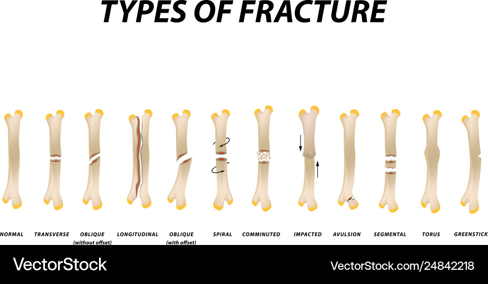 Types fracture fracture bone set infographics Vector Image