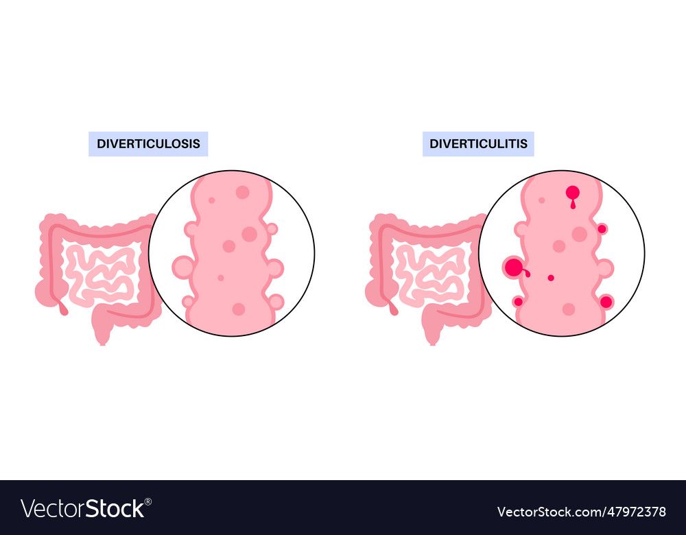 Diverticulitis And Diverticulosis Royalty Free Vector Image