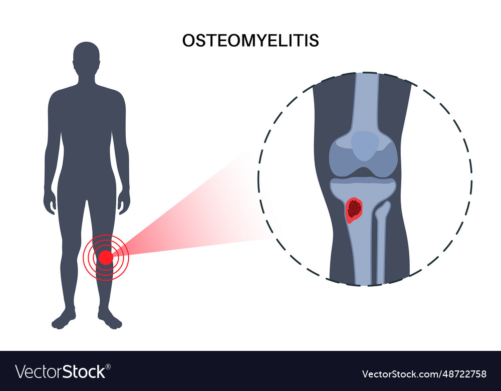 Tibia bone osteomyelitis Royalty Free Vector Image