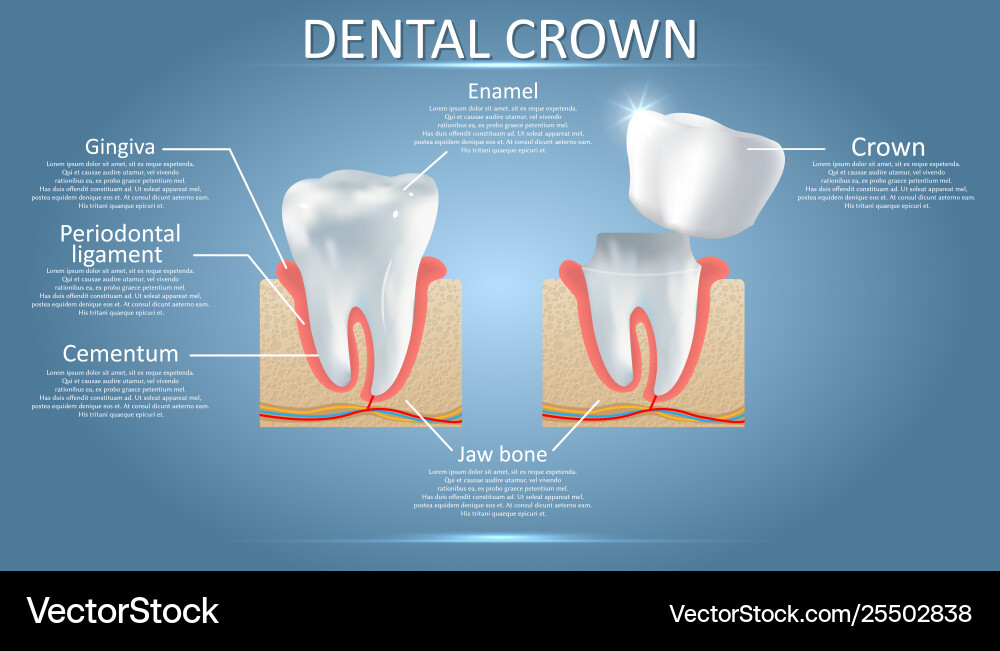 Human tooth and dental crown educational Vector Image