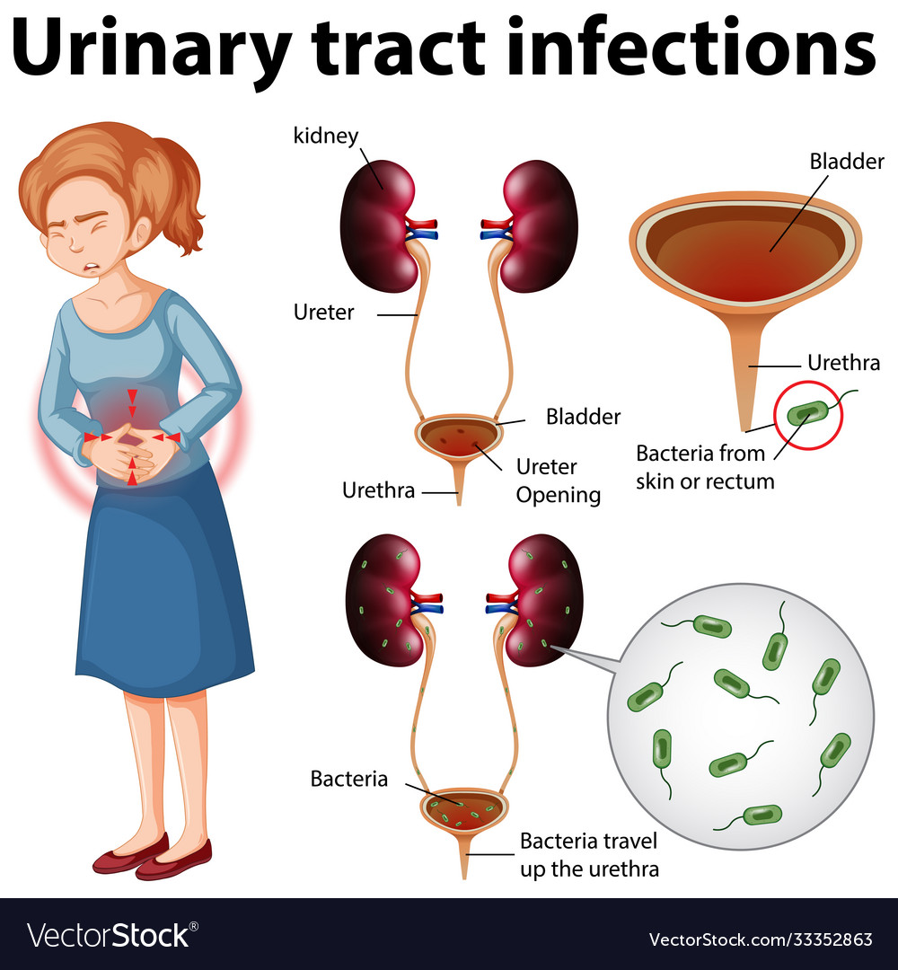 Informative Urinary Tract Infections Royalty Free Vector