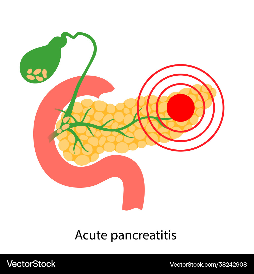 Pancreas disease and cancer Royalty Free Vector Image