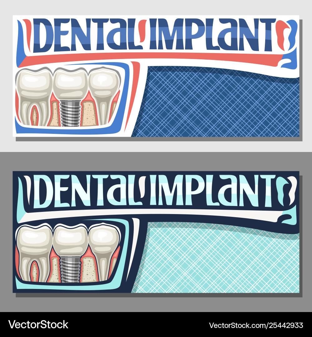 Banners for dental implant Royalty Free Vector Image