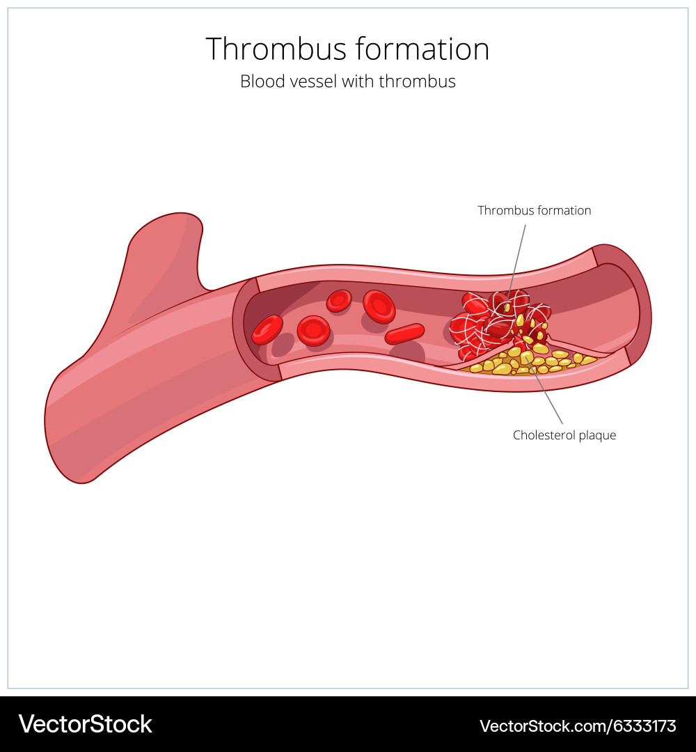 Blood vessel and clot thrombus Royalty Free Vector Image