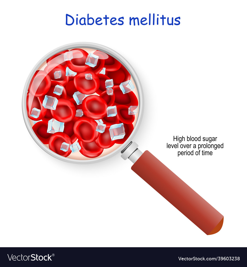 Diabetes Mellitus High Blood Sugar Level Vector Image