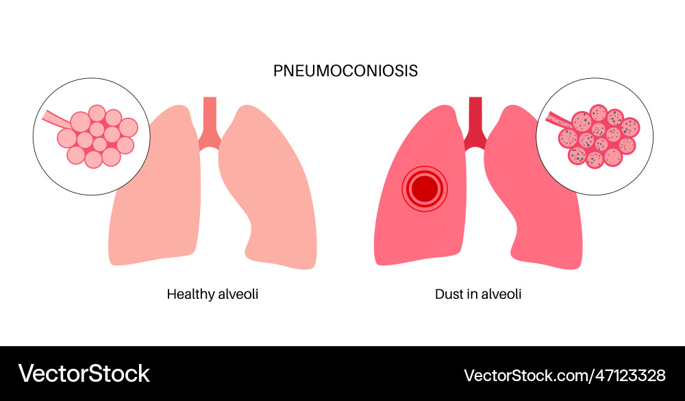 Pneumoconiosis lung disease Royalty Free Vector Image