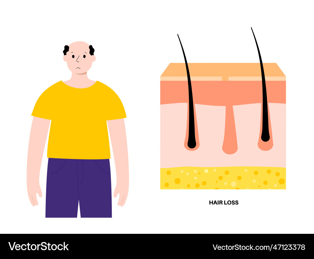 Hair loss treatment Royalty Free Vector Image - VectorStock
