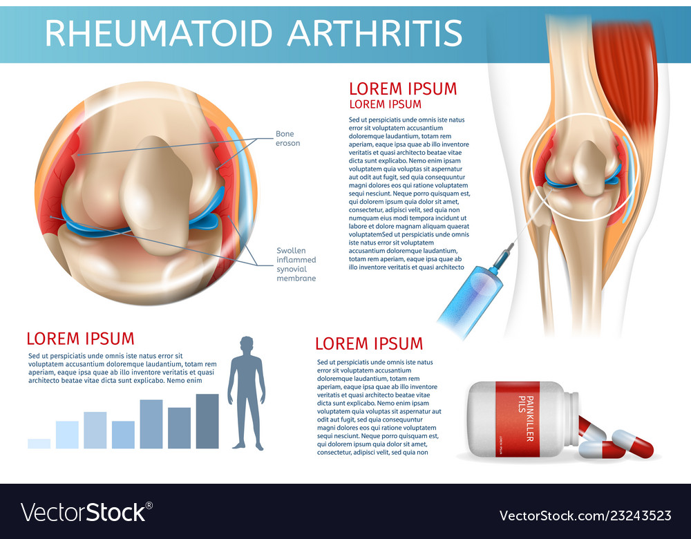 Infographic treatment method rheumatoid arthritis Vector Image