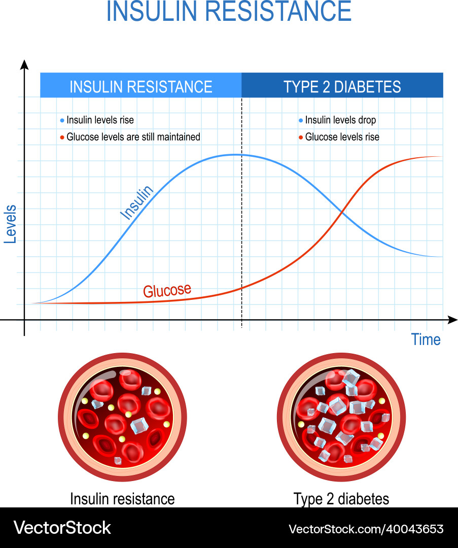 Insulin resistance and type 2 diabetes Royalty Free Vector
