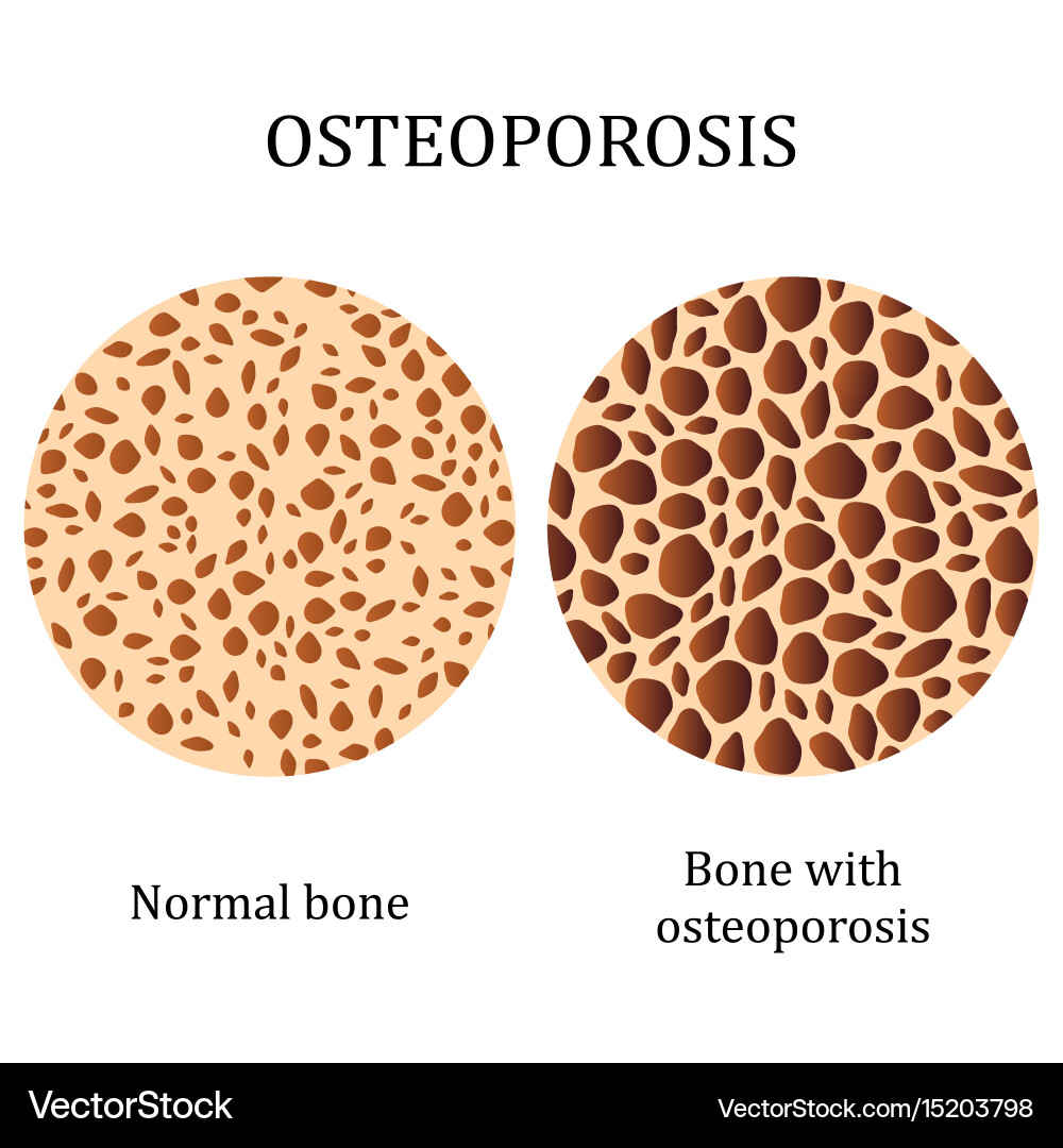 Healthy bone and bone with osteoporosis Royalty Free Vector