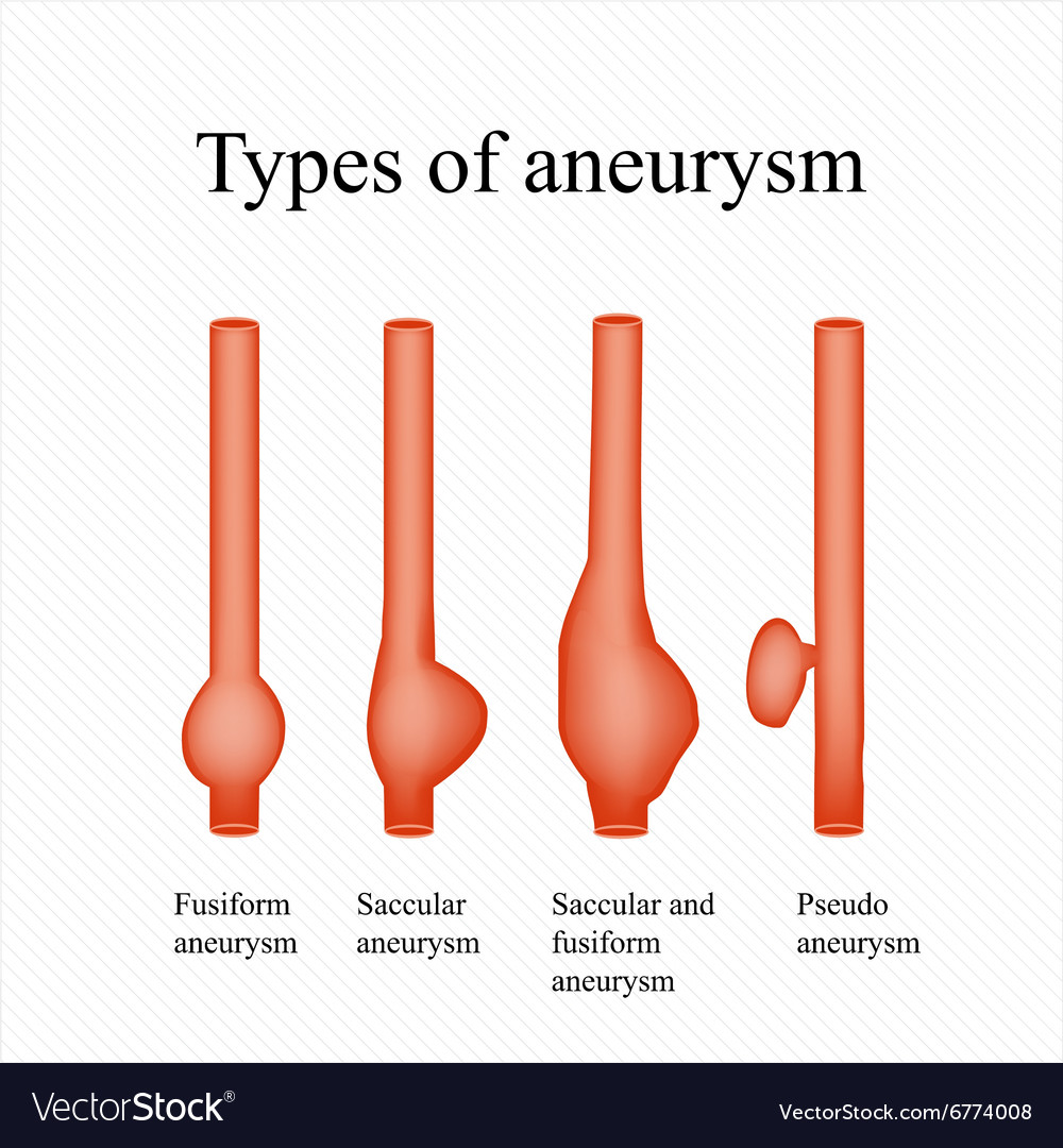 Aneurysm Types Aneurysm Infographics Royalty Free Vector
