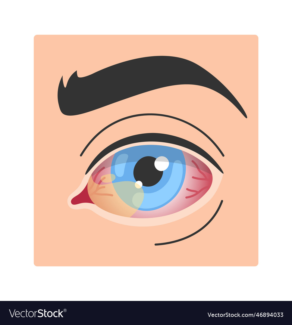 Pterygium human eye disease Royalty Free Vector Image Pterygium human eye disease Royalty Free Vector Image