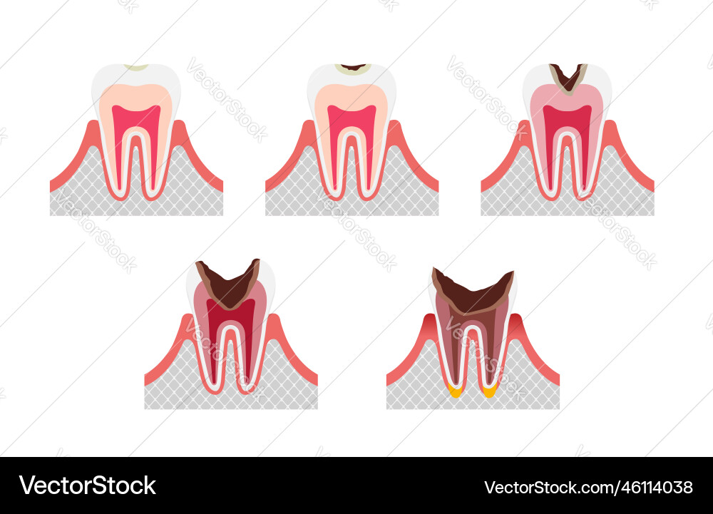 Stages of tooth decay flat set Royalty Free Vector Image