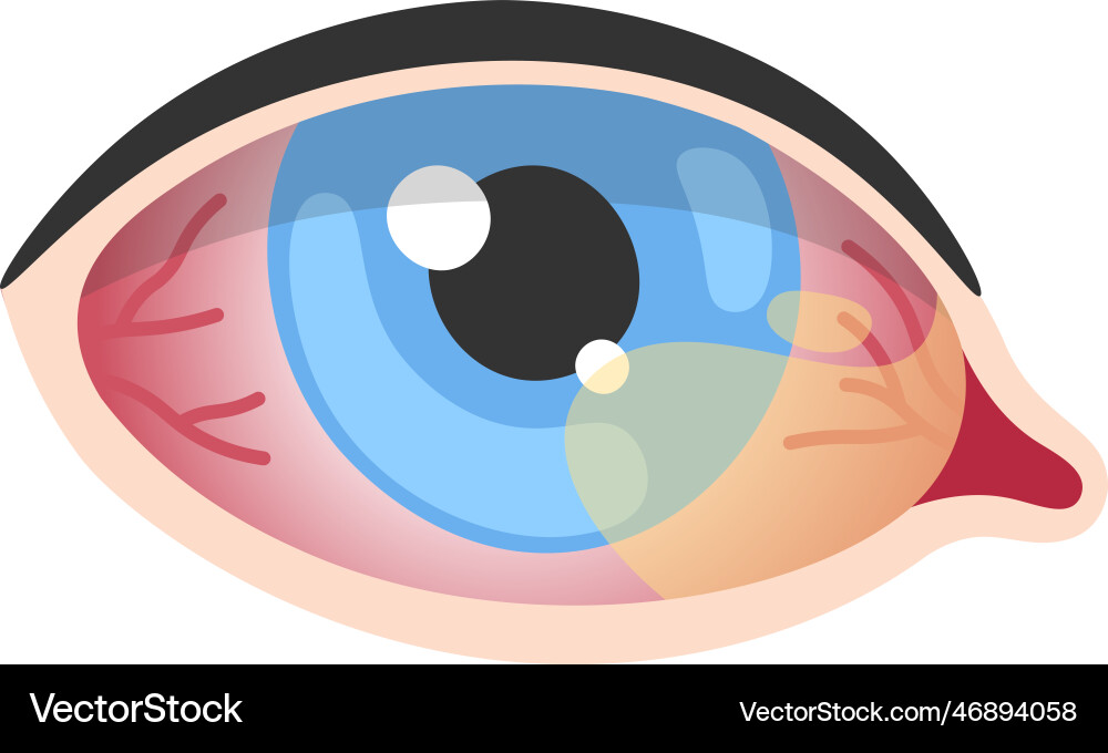 Pterygium human eye disease Royalty Free Vector Image