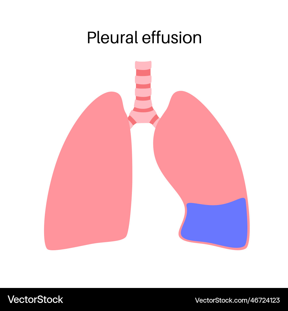 Pleural effusion poster Royalty Free Vector Image