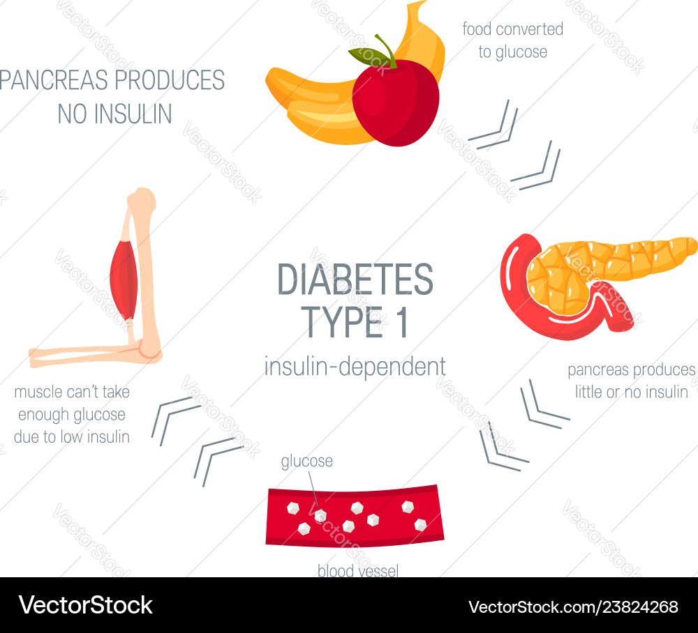 Diabetes type 1 concept in flat style Royalty Free Vector
