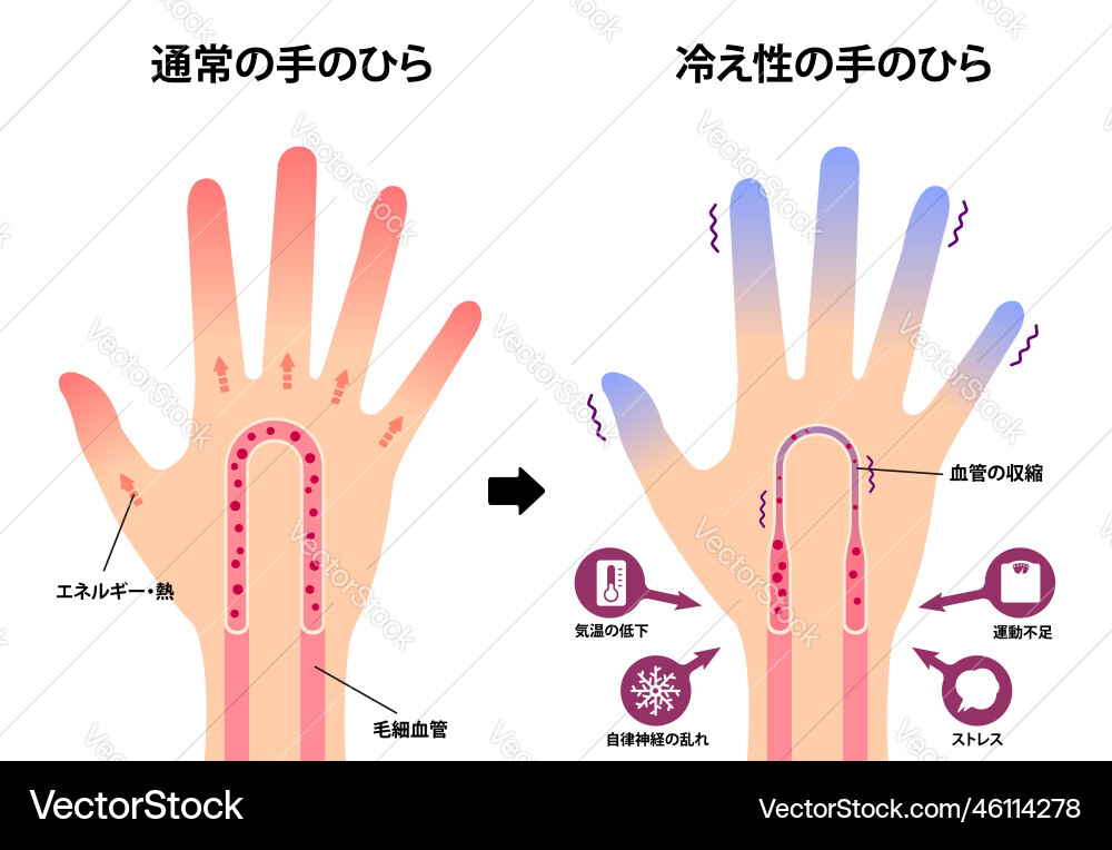 Comparison of normal hand and cold hand Royalty Free Vector