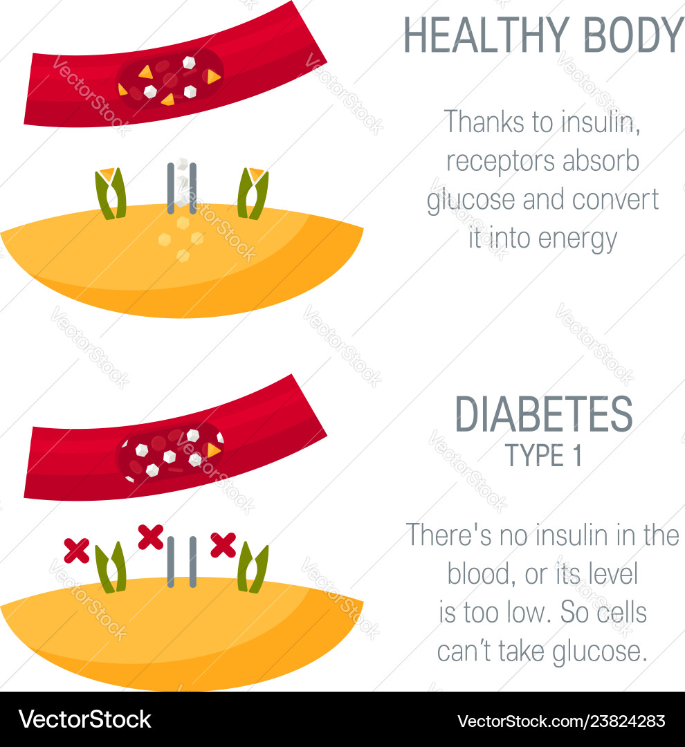 Diabetes type 1 concept in flat style Royalty Free Vector