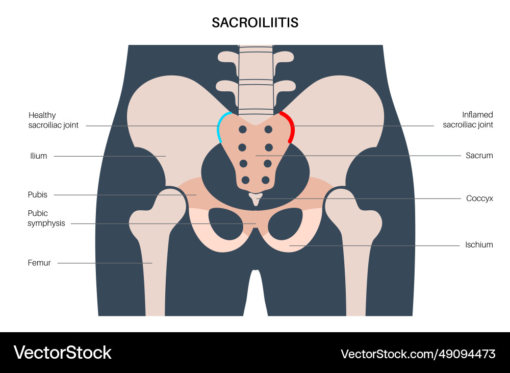 Sacroiliitis medical poster Royalty Free Vector Image