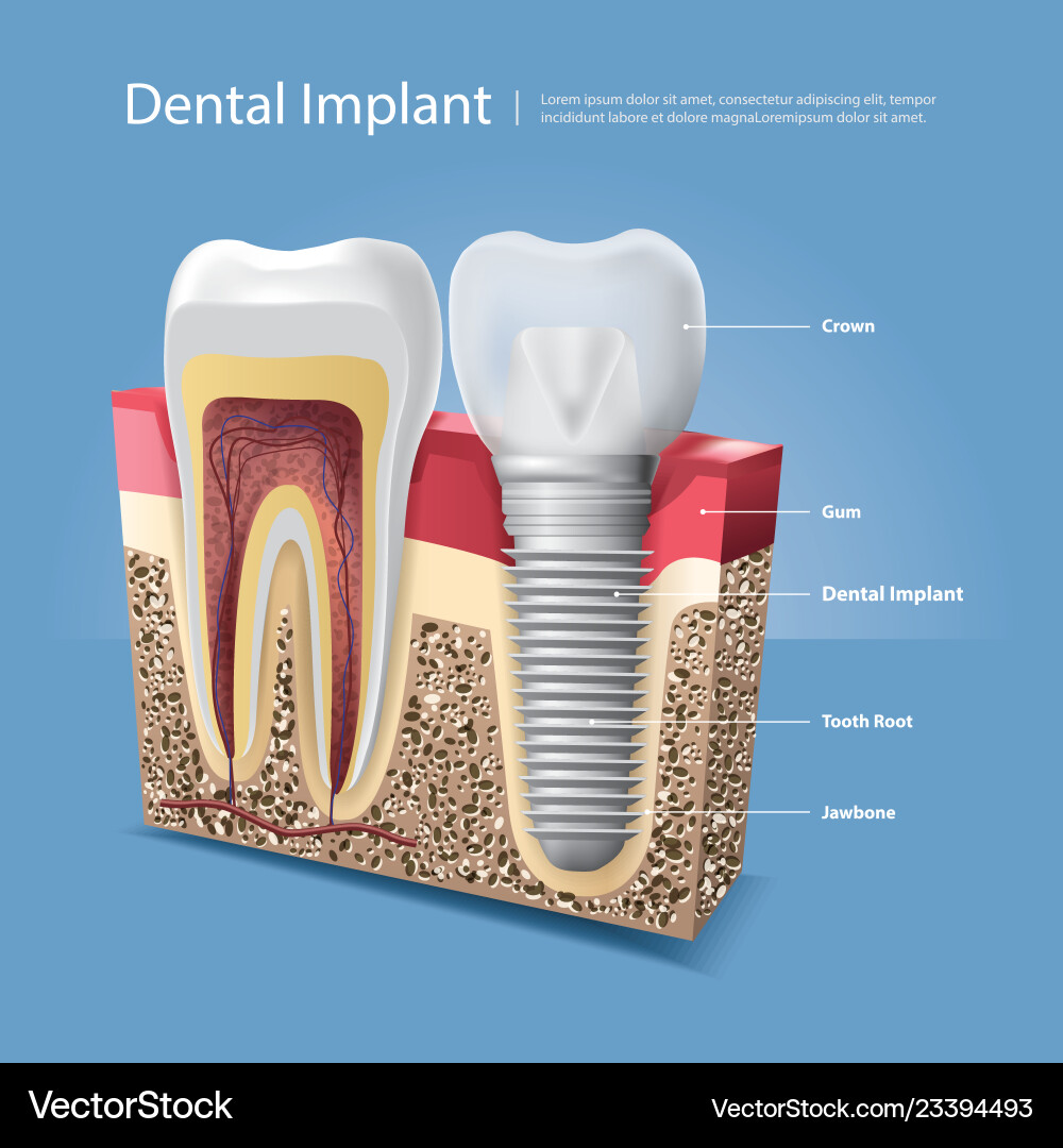 Human teeth and dental implant Royalty Free Vector Image