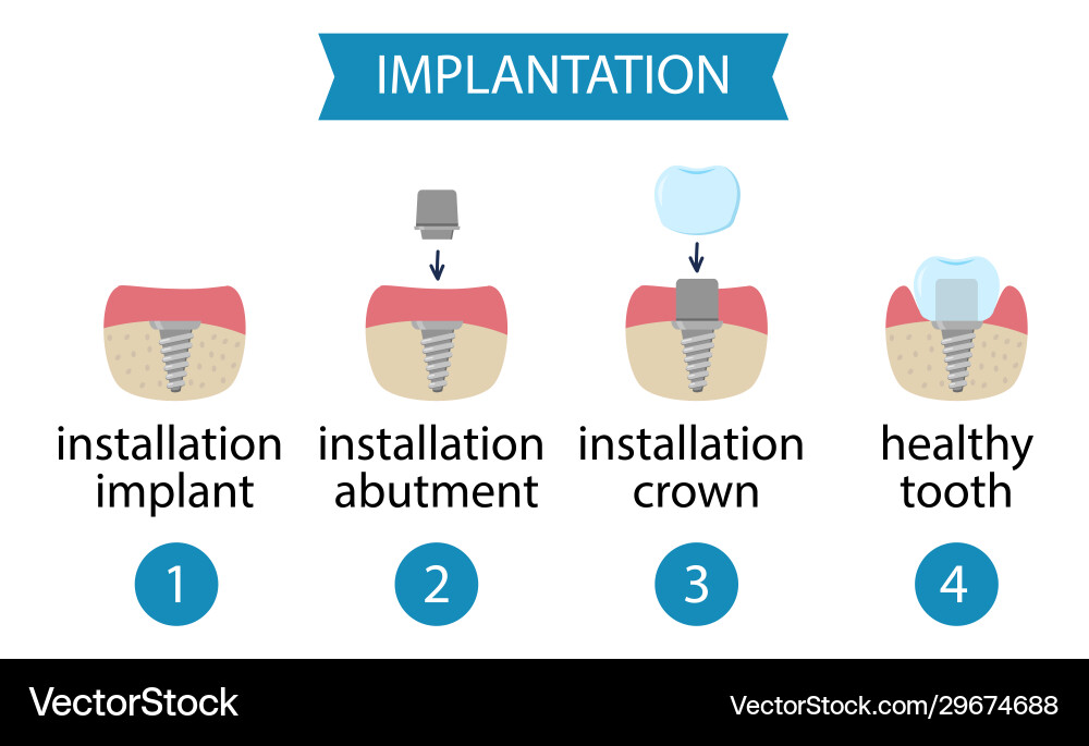 Infographics dental implantation process Vector Image