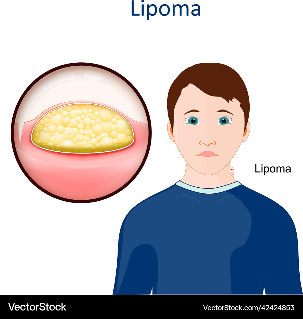 Lipoma skin disease Royalty Free Vector Image - VectorStock