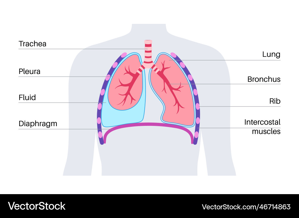 Pleural Effusion Medical Diagram Royalty Free Vector Image