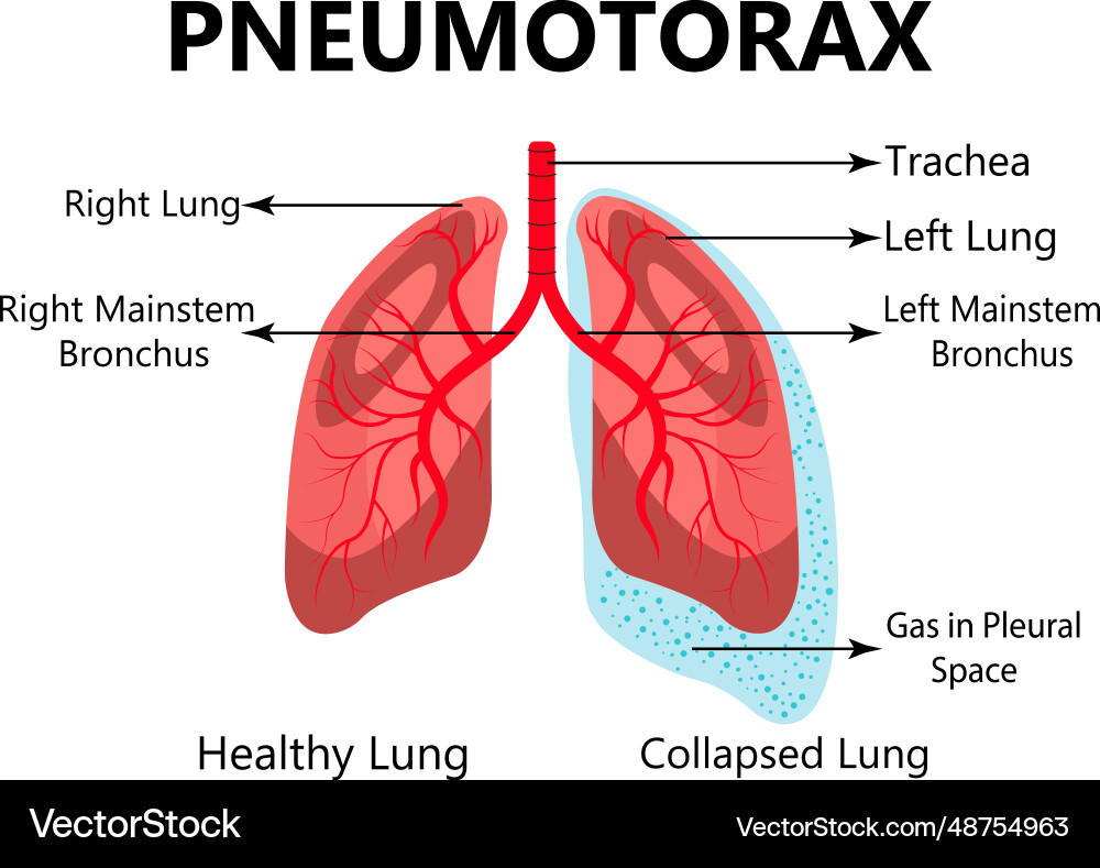 Pneumonia the anatomical structure of human Vector Image