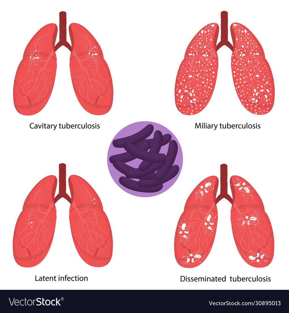 Tuberculosis Royalty Free Vector Image - VectorStock