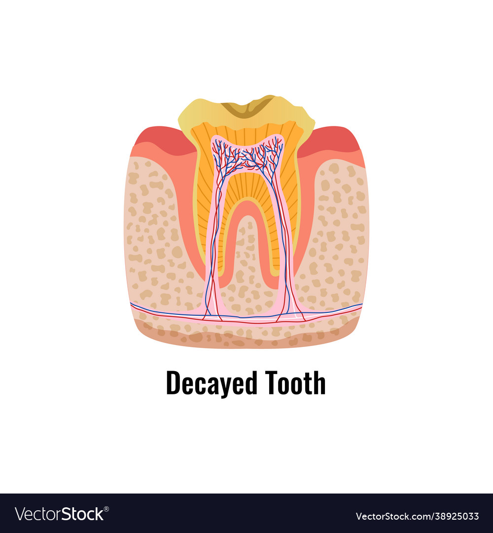 Decayed tooth poster Royalty Free Vector Image