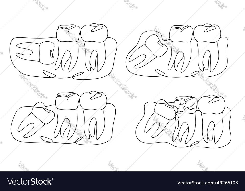 Wisdom tooth impacted teeth one line Royalty Free Vector Wisdom tooth impacted teeth one line Royalty Free Vector