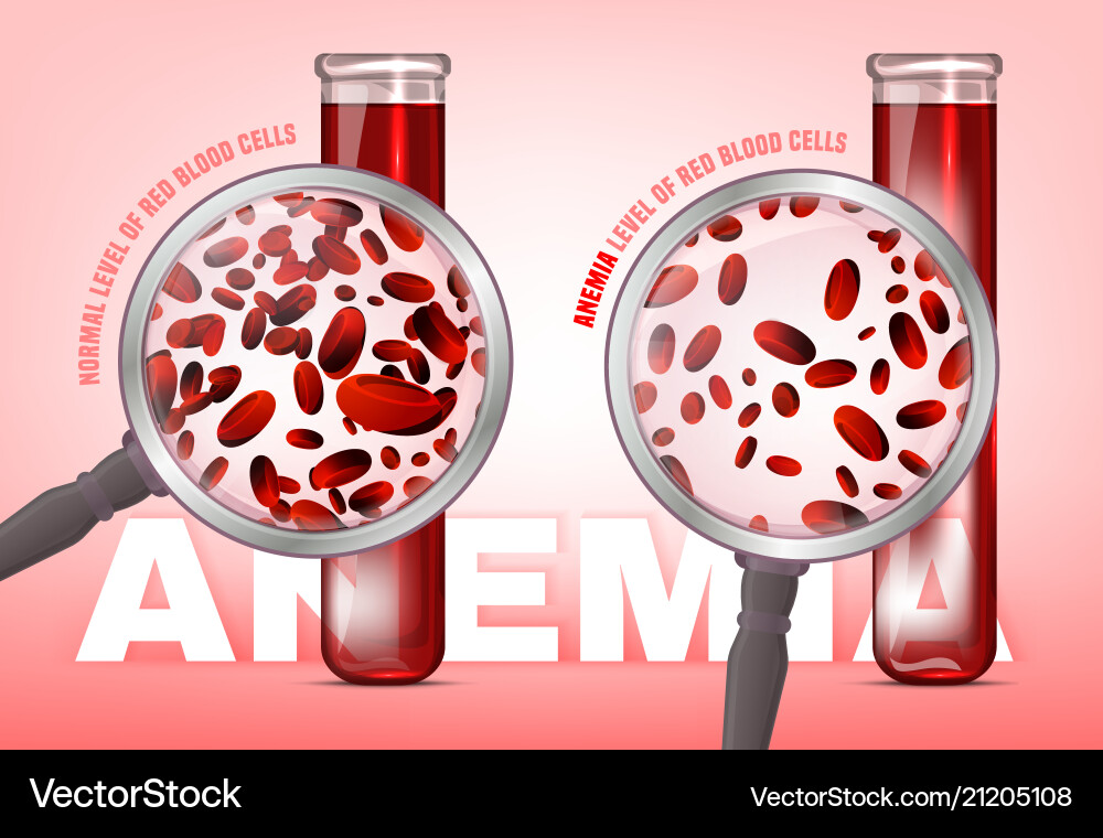 Anemia level blood cells Royalty Free Vector Image