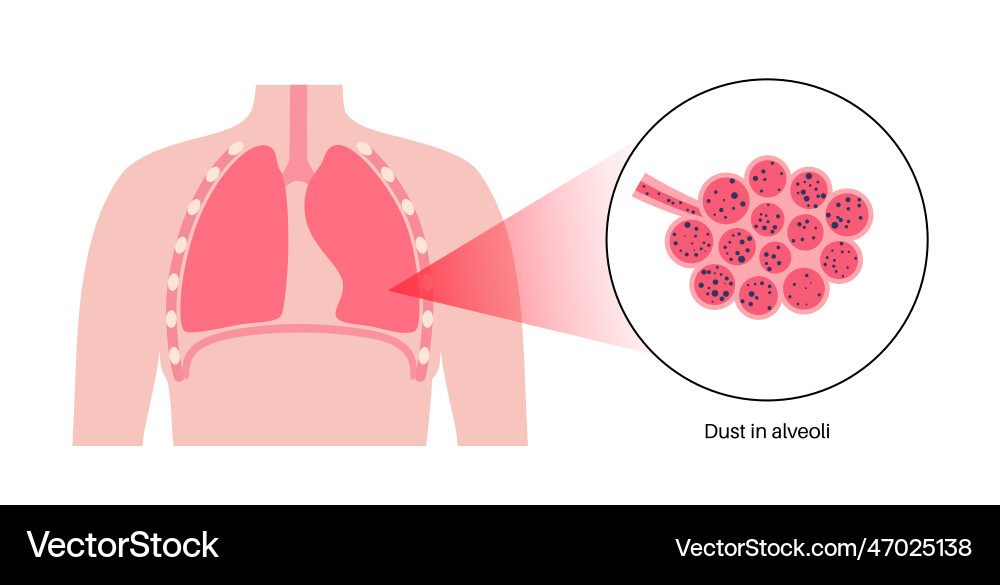 Pneumoconiosis lung disease Royalty Free Vector Image